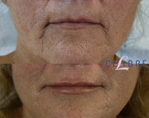 Juvederm Before and After Pictures of Actual Patients