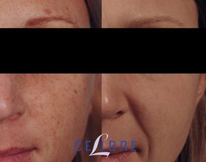 Age Spot Removal Before and After Pictures