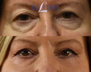 Laser Resurfacing Before and After Pictures of Actual Patients