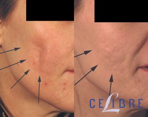 Scar Removal Before and After Pictures