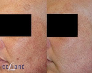 Age Spot Removal Before and After Pictures