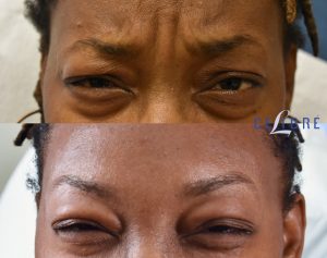Botox Before and After Pictures: Real Results from Real Patients