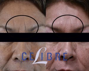 Get Rid of Frown Lines