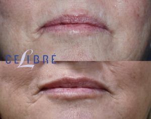 Lip Filler Before and After Pictures | Book Appointment