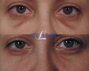 Understanding Hemosiderin Staining: Causes, Symptoms, and Treatment