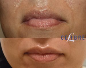 Lip Filler Before and After Pictures | Book Appointment