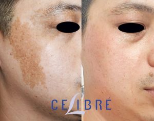 Café-au-Lait Birthmark Removal