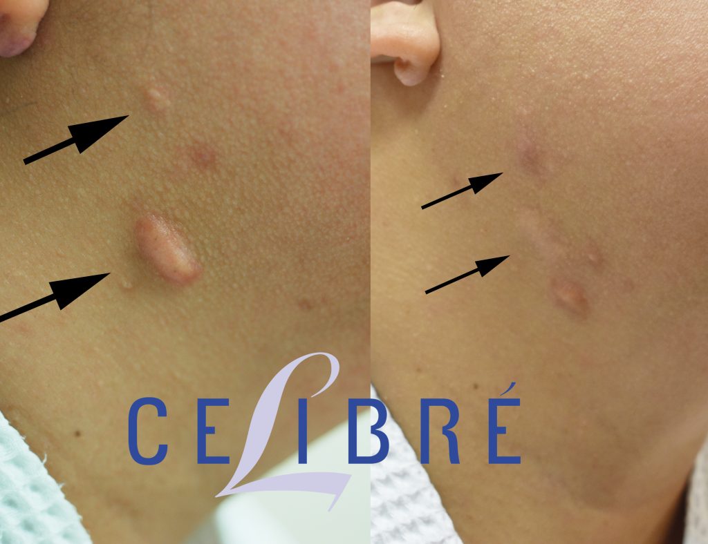 Keloid Scar Removal with Steroid Injections
