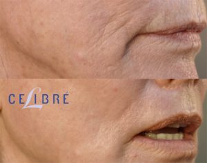 Botox For Smokers Lines Before And After | Book Appointment