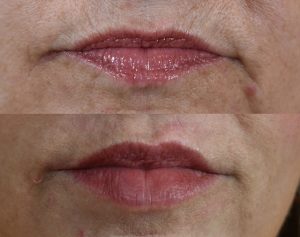 Juvederm Before and After Pictures of Actual Patients