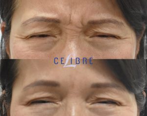 Botox Before and After Pictures: Real Results from Real Patients