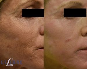 Age Spot Removal Before and After Pictures