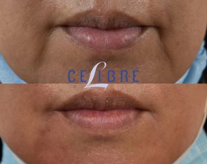 Juvederm Before and After Pictures of Actual Patients