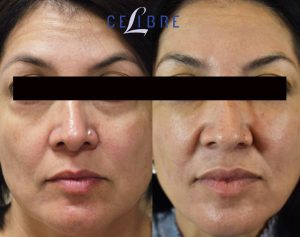 Juvederm Before and After Pictures of Actual Patients