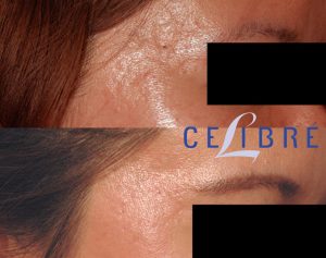 Laser Scar Removal in Torrance and Los Angeles