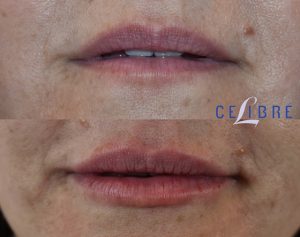 Juvederm Before and After Pictures of Actual Patients