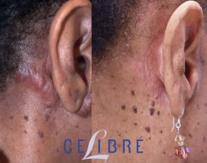 Laser Scar Removal in Torrance and Los Angeles