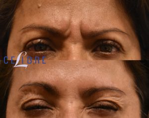 Dysport Before and After Pictures of Actual Patients