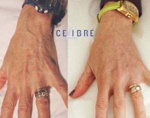 Radiesse Before and After Pictures