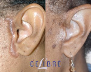 Keloid Scar Removal with Steroid Injections