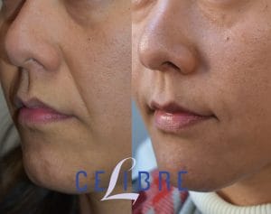 Juvederm Before and After Pictures of Actual Patients