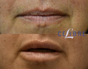 Lip Filler Before and After Pictures | Book Appointment