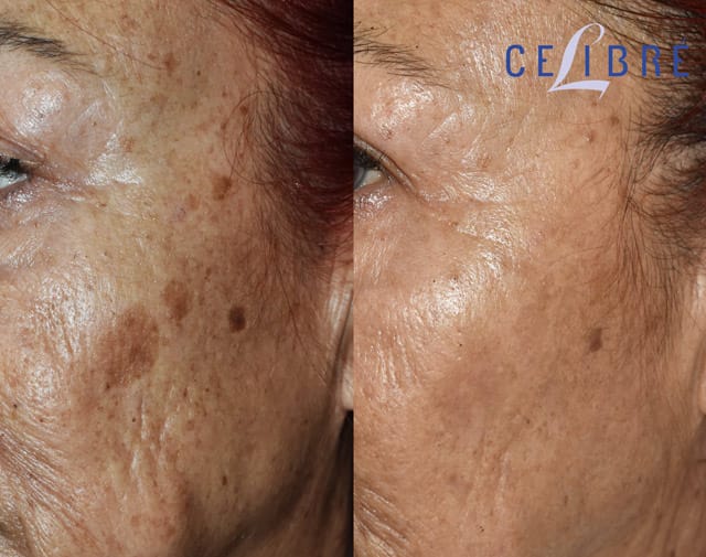Sunspots On Face Treatment Sunspots On Face Treatment