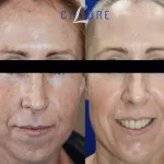 Age Spot Removal Before and After Pictures