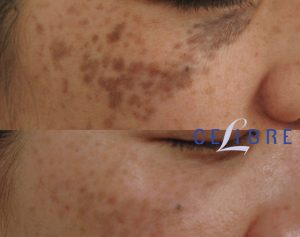 Birthmark Removal Before and After Pictures