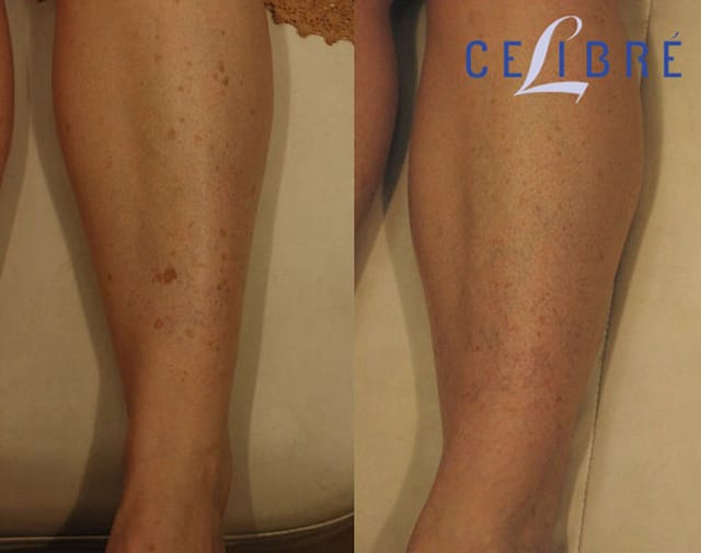 Light Brown Spots Appearing On Legs Americanwarmoms Org