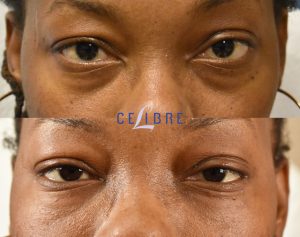 Under Eye Filler Dark Circles [ Before And After]