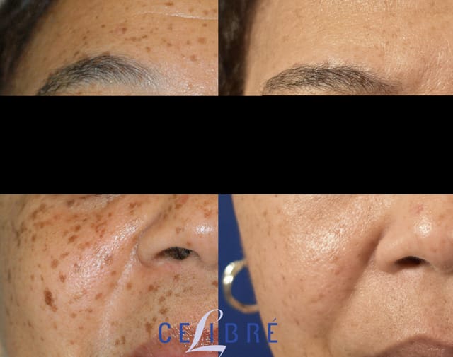 Dermatologist Treatment For Dark Spots On Face Shop Authentic Www Dermatologist Treatment For Dark Spots On Face Shop Authentic Www