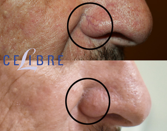 Spider Vein Removal Before And After Pictures