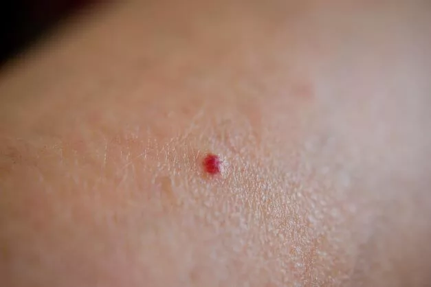 Everything You Need to Know about Angioma Removal