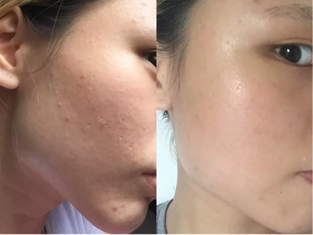 Before-After Skin Condition: Our Definitive Guide