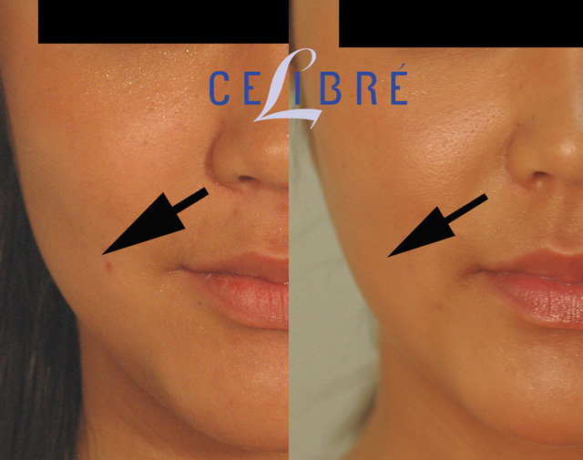 Botox Before and After Pictures – See Real Results at Celibre