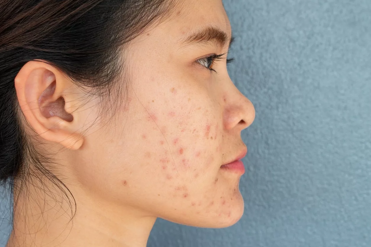 Treating Brown and Red Acne Scars with Effective Solutions
