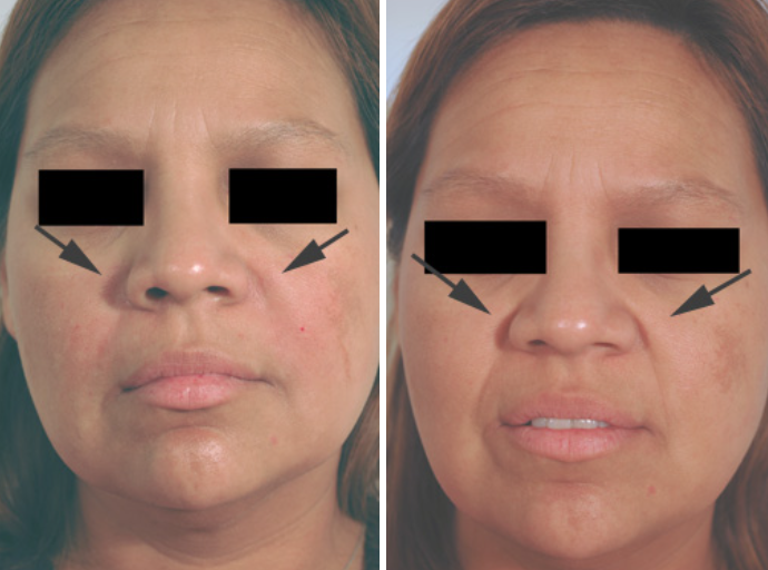 Cheek Augmentation With Perlane injections