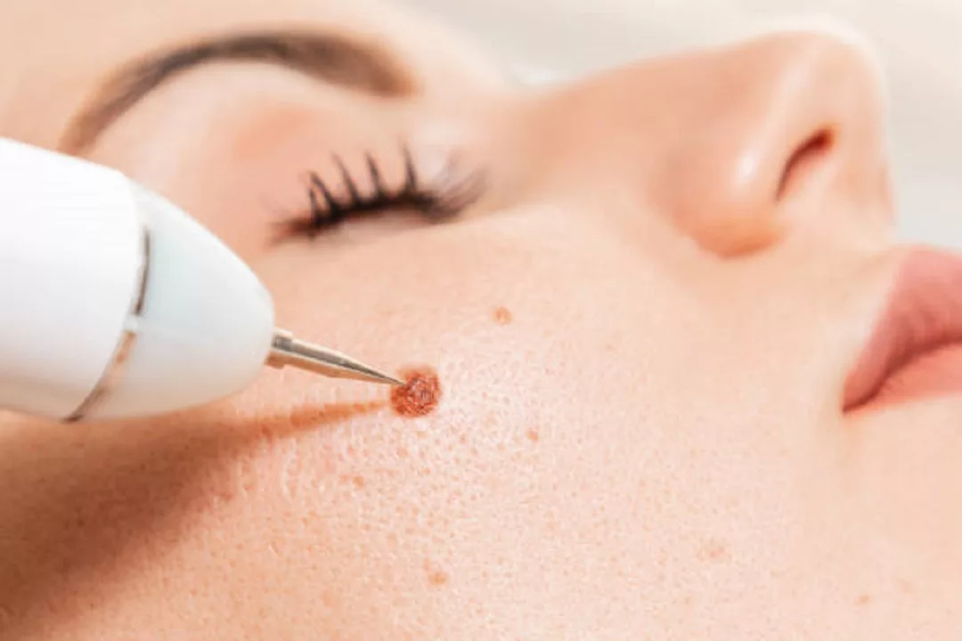 Laser for Cherry Angiomas | Safe & Effective Treatment