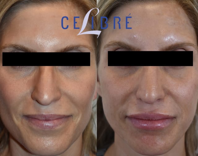 Sculptra Injection Cost in 2026: $650–$1000 Per Vial