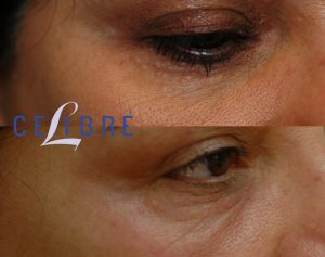 What is Syringoma and How Can It Be Treated?