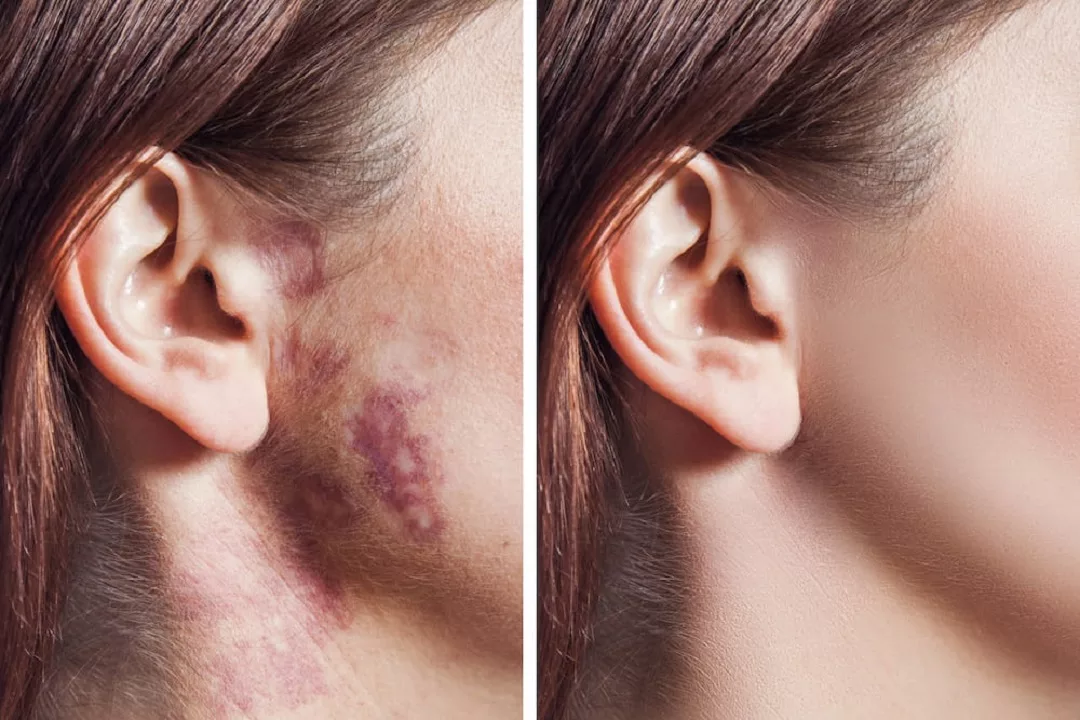 The Ultimate Guide To Laser Treatments For Birthmarks
